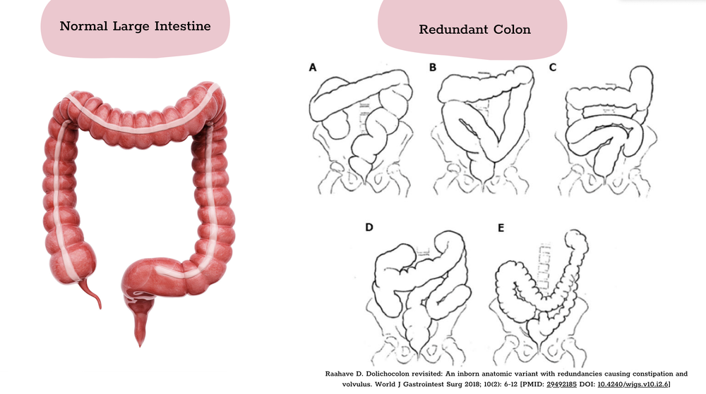 The Endo Belly Problem You’ve Never Heard Of: A Redundant Colon — Heal Endo